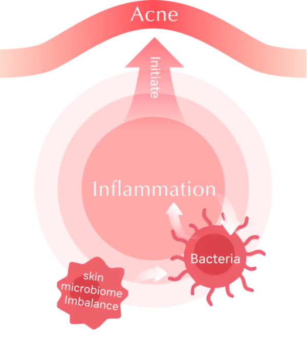 Bacterial Battles: How Microbes Fuel the Fire of Acne Inflammation | Voibon