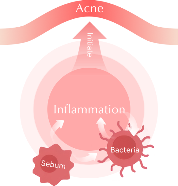 The Acne Revolution: Inflammation as the True Enemy | Voibon