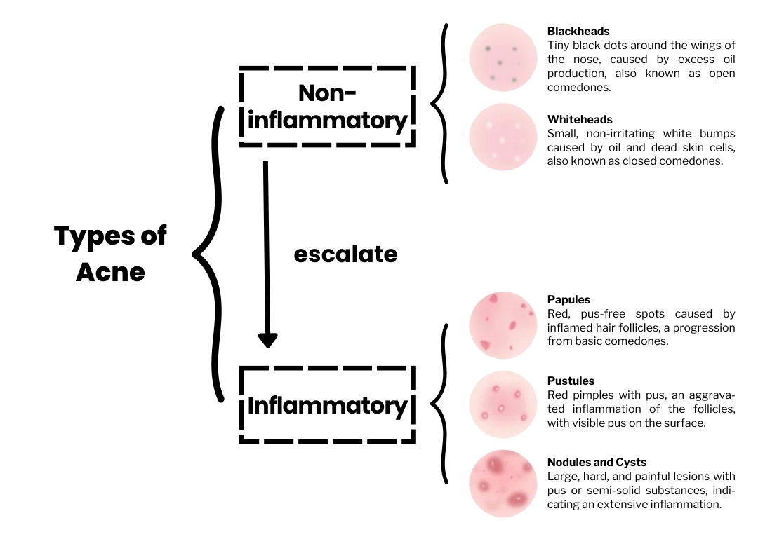When Acne Turns Angry: The Inflammatory Side of Breakouts